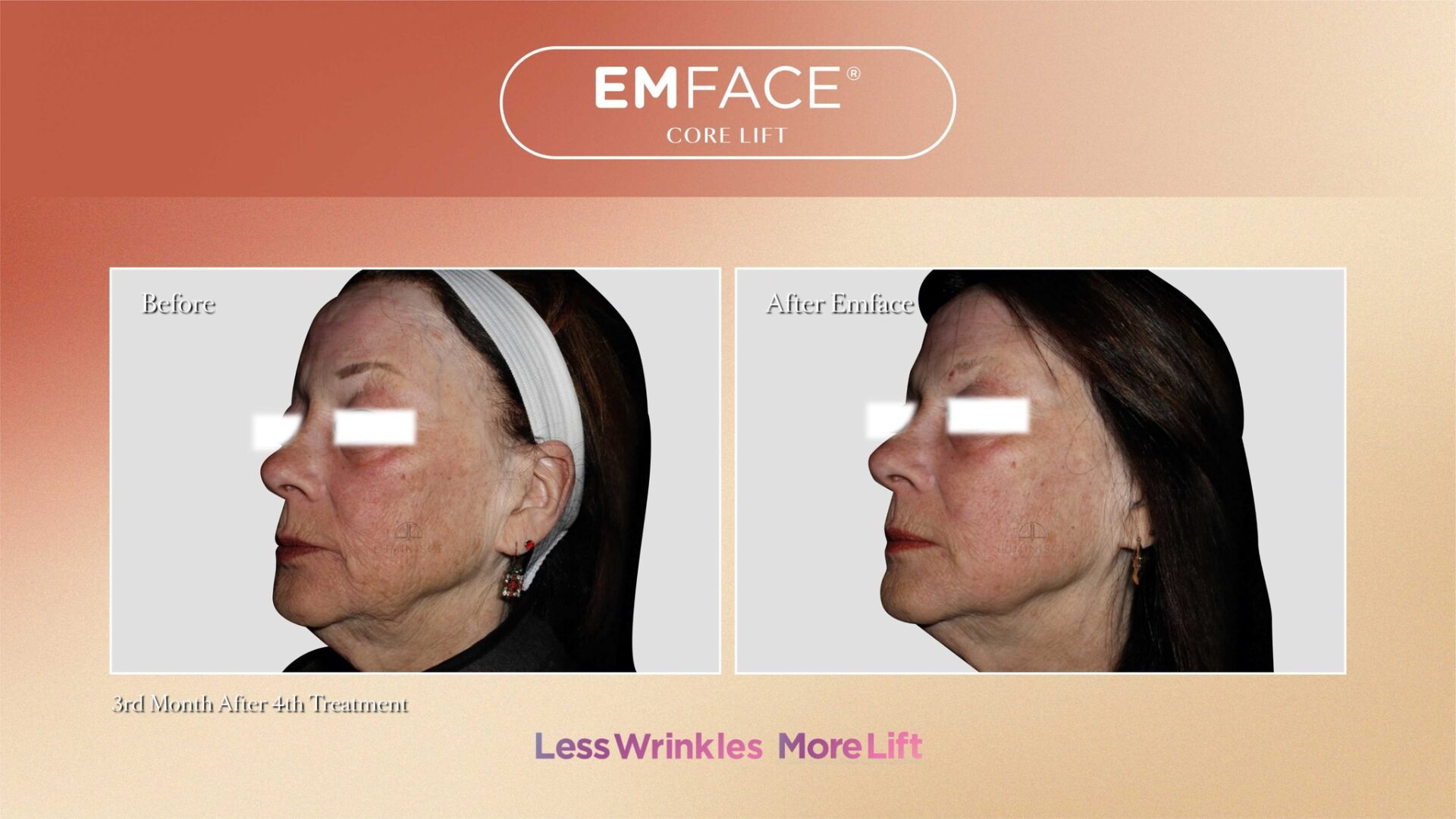 Luminisce introduces EMFACE, a ground-breaking anti-aging technology ...